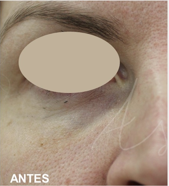 Como eliminar as olheiras - Causas e Soluções.